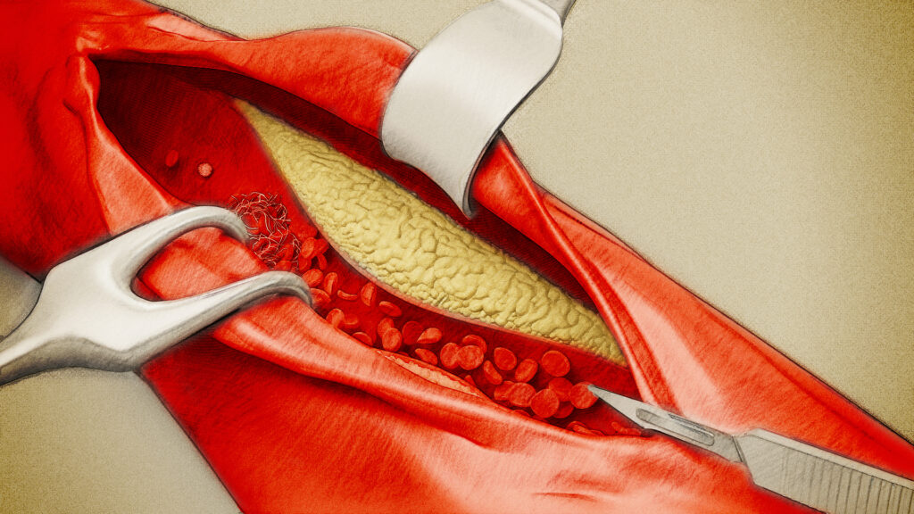 Early Signs of Peripheral Artery Disease: What to Watch For