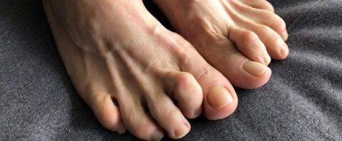 Hammer Toe Correction: What You Need to Know