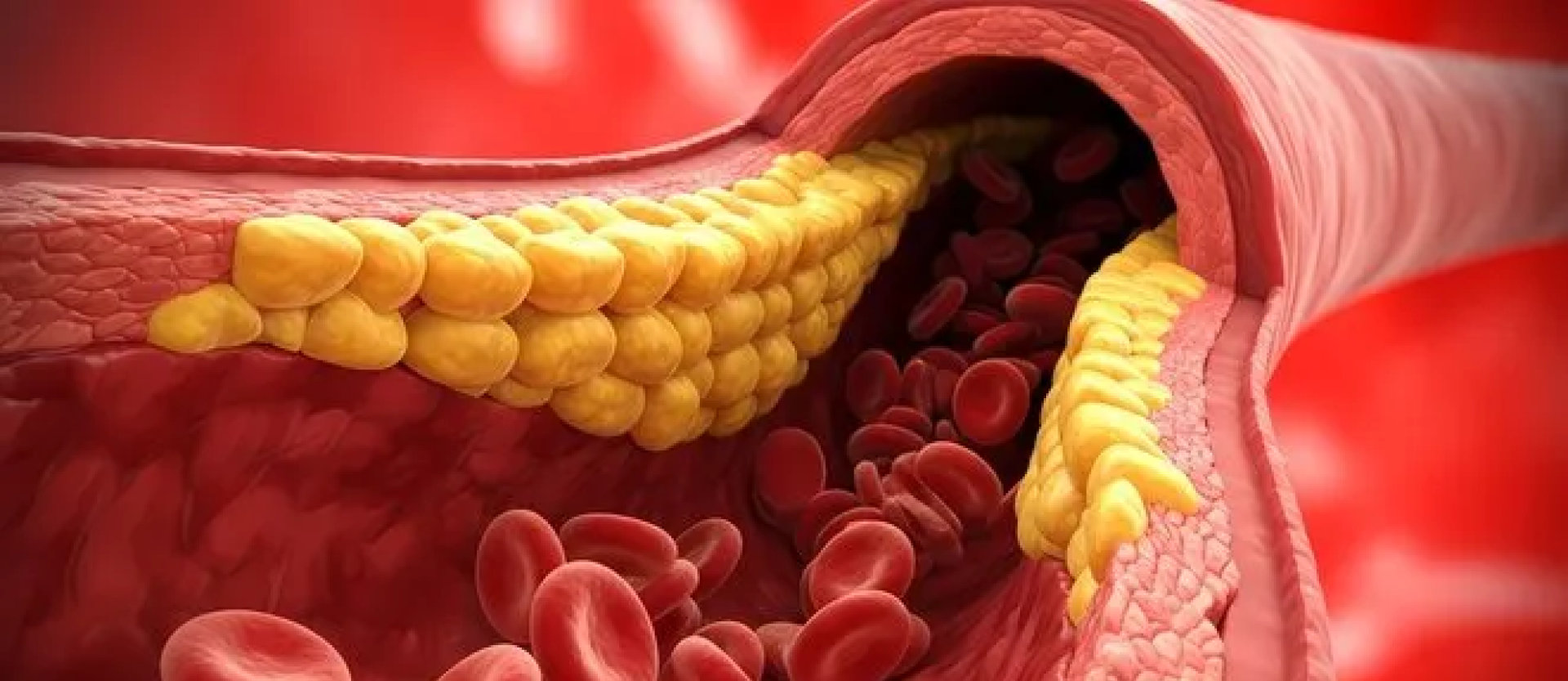 Peripheral Artery Disease (PAD): A Silent Threat to Foot and Vascular ...